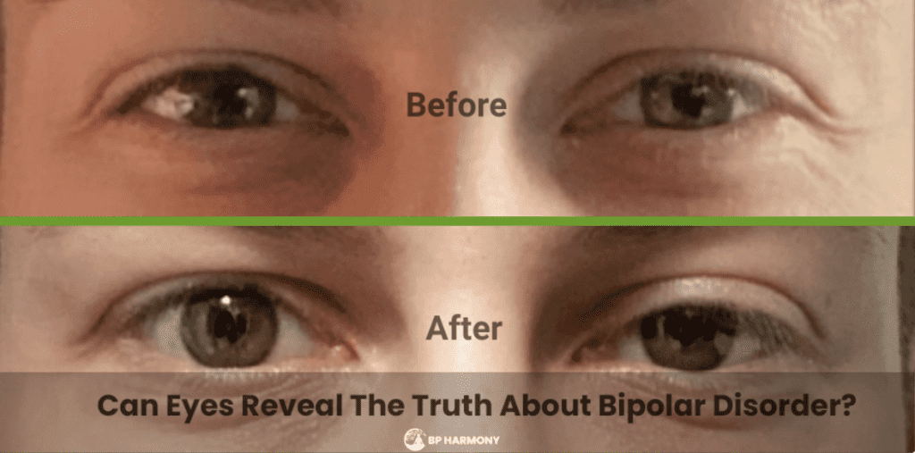 Can Eyes Reveal The Truth About Bipolar Disorder - BP Harmony
