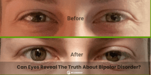 Can Eyes Reveal The Truth About Bipolar Disorder - Bp Harmony